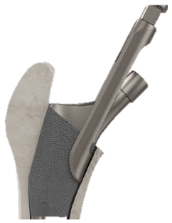 Watson Extraction System