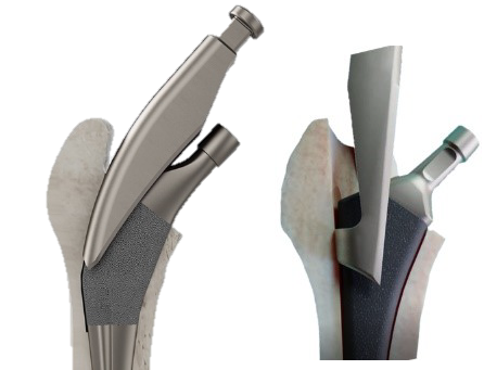 Watson Extraction System